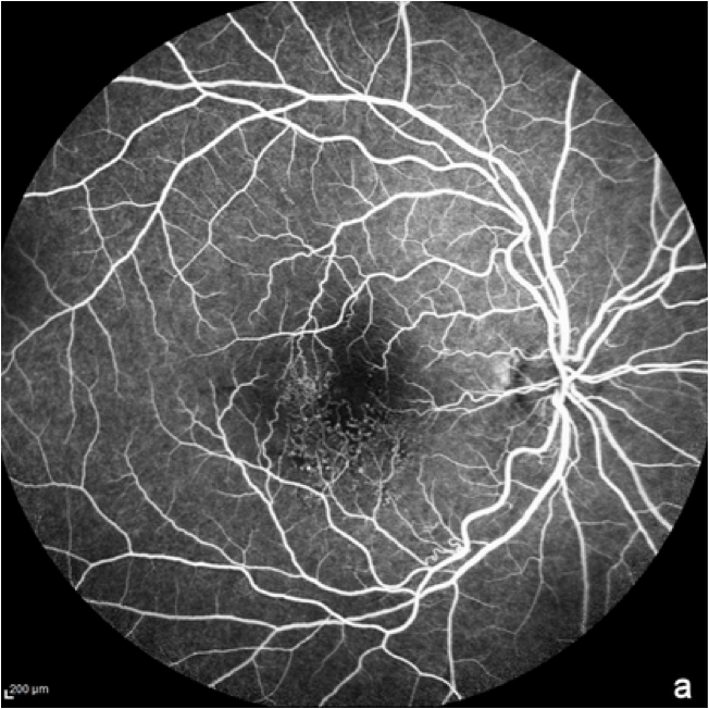 Age-Related Macular Degeneration | Diagnosis of dry AMD