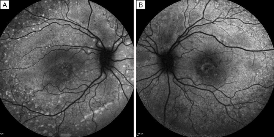 Age-Related Macular Degeneration | Diagnosis of dry AMD