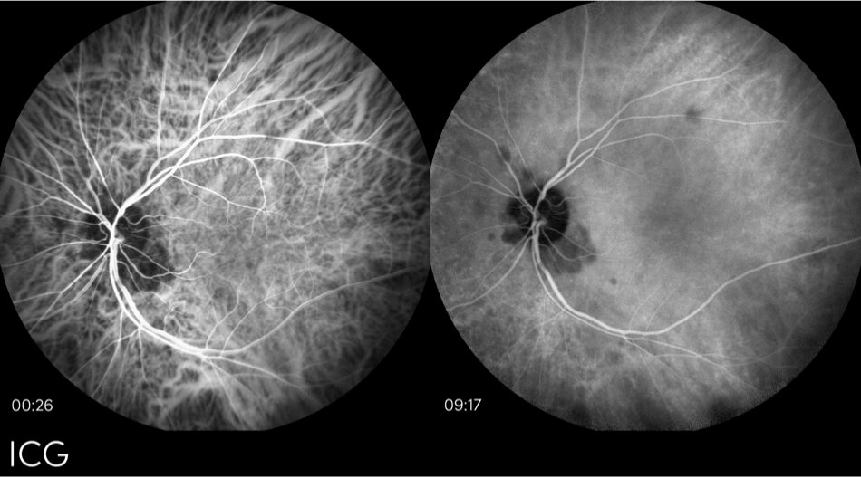 Age-Related Macular Degeneration | Diagnosis of dry AMD